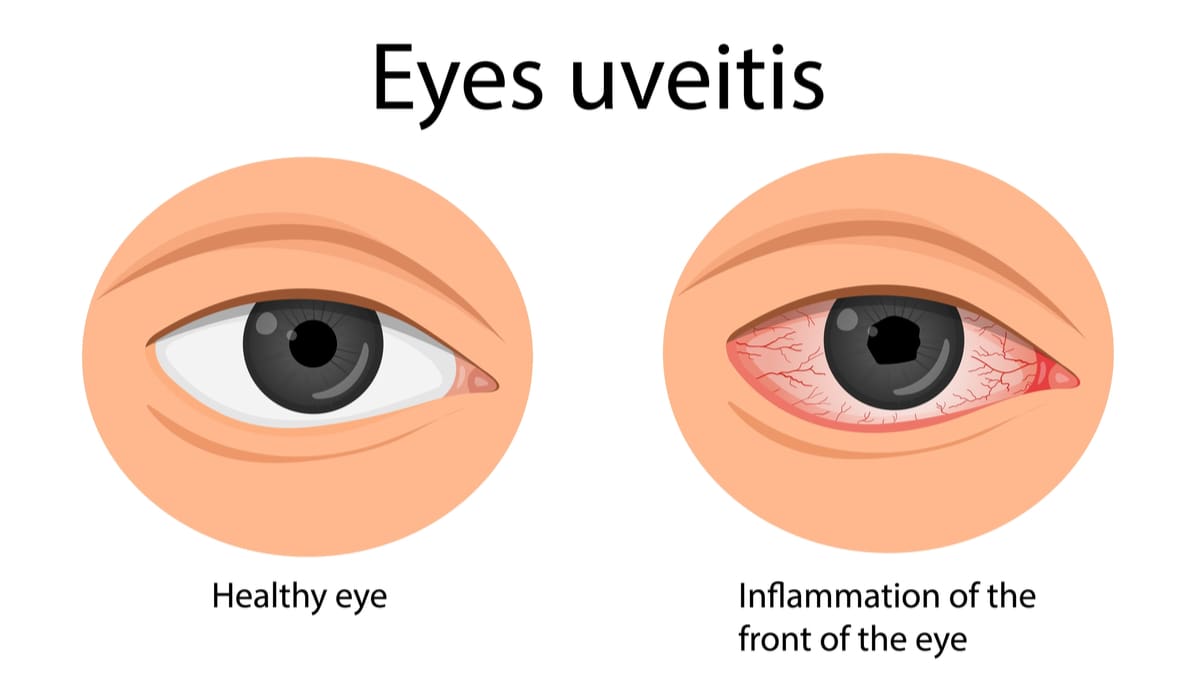 Uveitis Guide Types Symptoms Causes And Treatments MyVision Uveitis Guide Types Symptoms Causes And Treatments MyVision