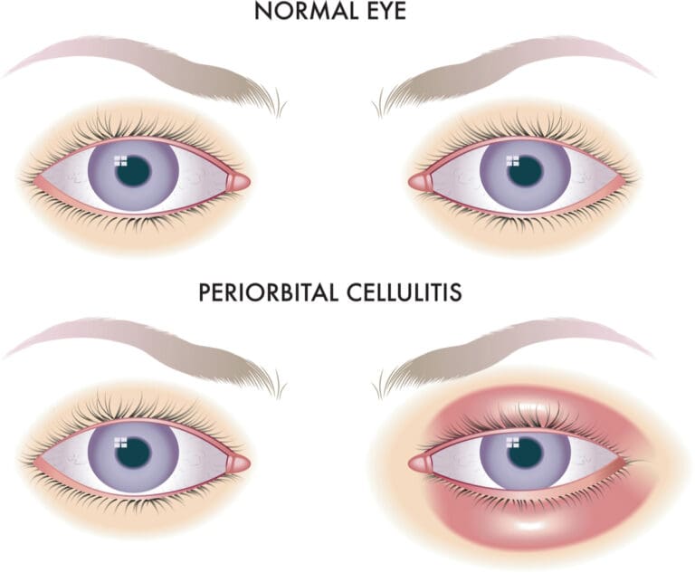 Periorbital Cellulitis | MyVision.org