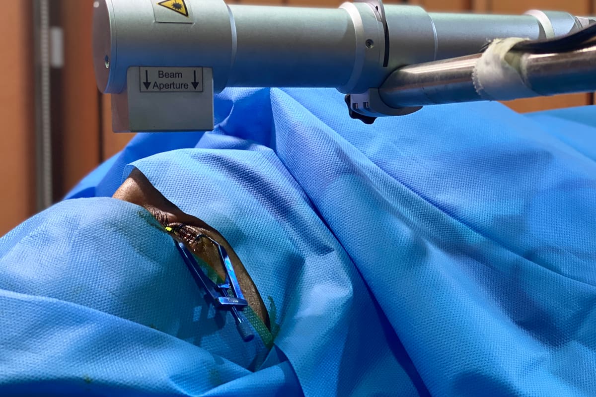 Intacs Surgery: Uses, the Procedure, Outcomes & More | MyVision.org