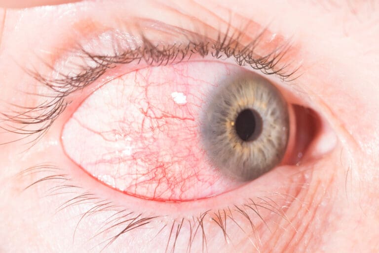 Episcleritis: Causes and Treatment | MyVision.org