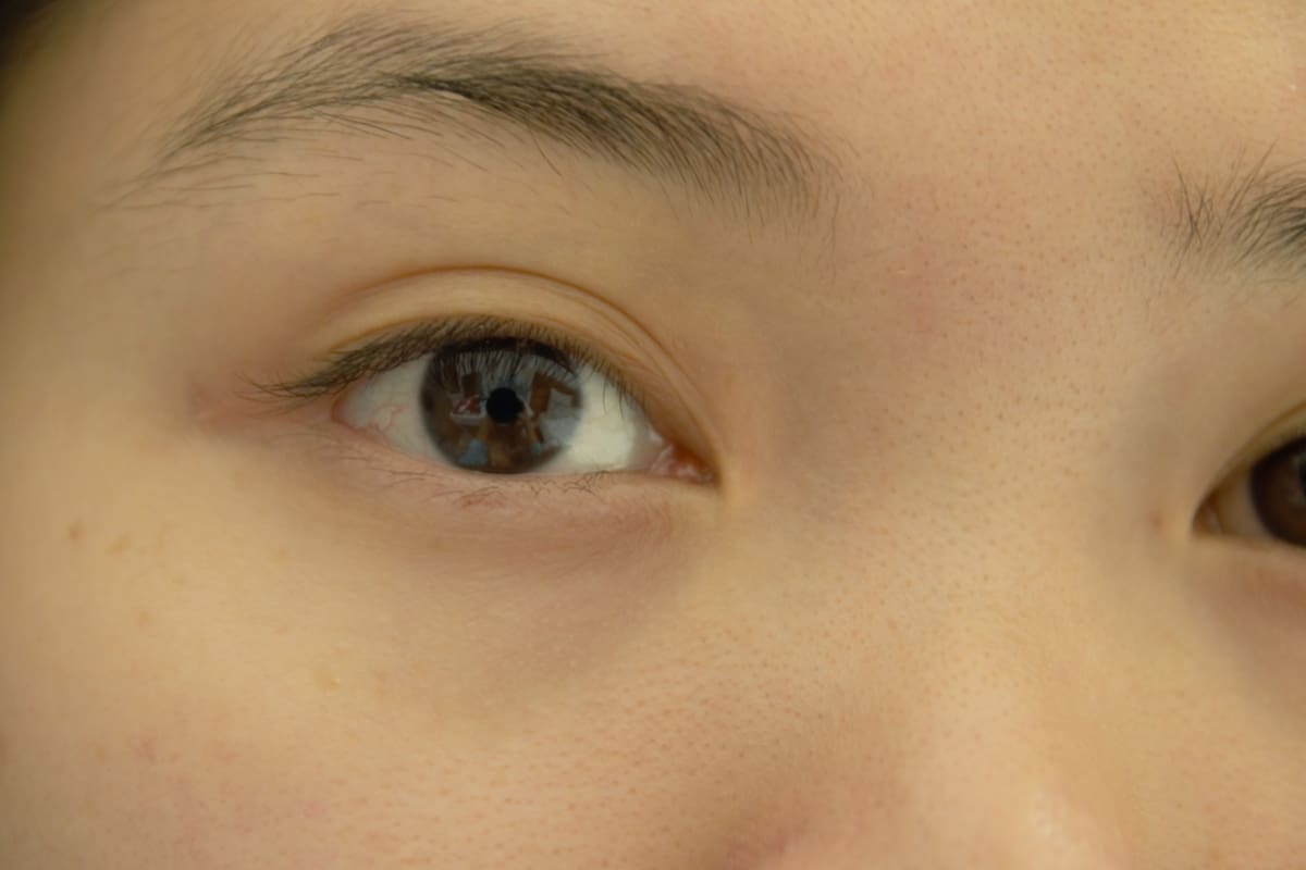 Eyebrow Twitching: Causes and Treatments | MyVision.org