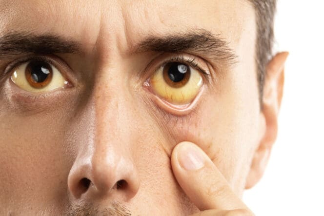 Eye Conditions & Diseases: What You Need to Know | MyVision.org