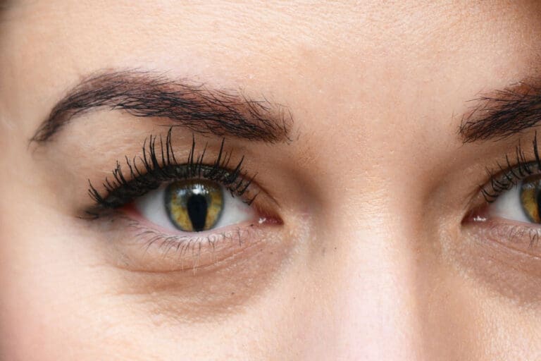 Coloboma: What Is It, Causes & Treatment | MyVision.org