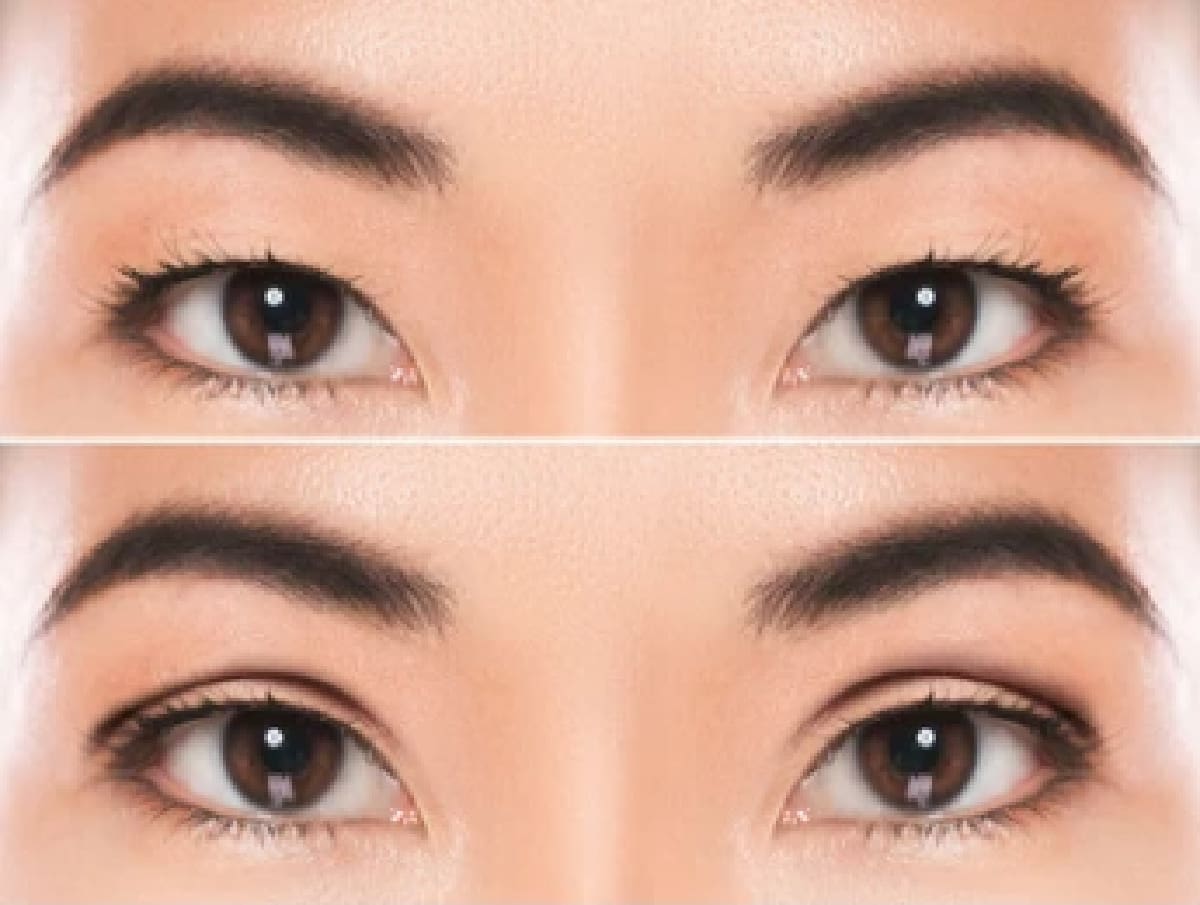 Double Eyelid Surgery: Costs, The Procedure, Risks & More | MyVision.org