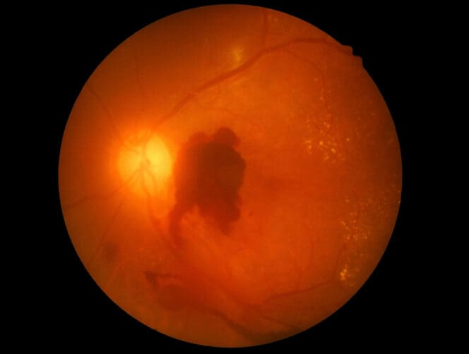 Eye Conditions & Diseases: What You Need to Know | MyVision.org