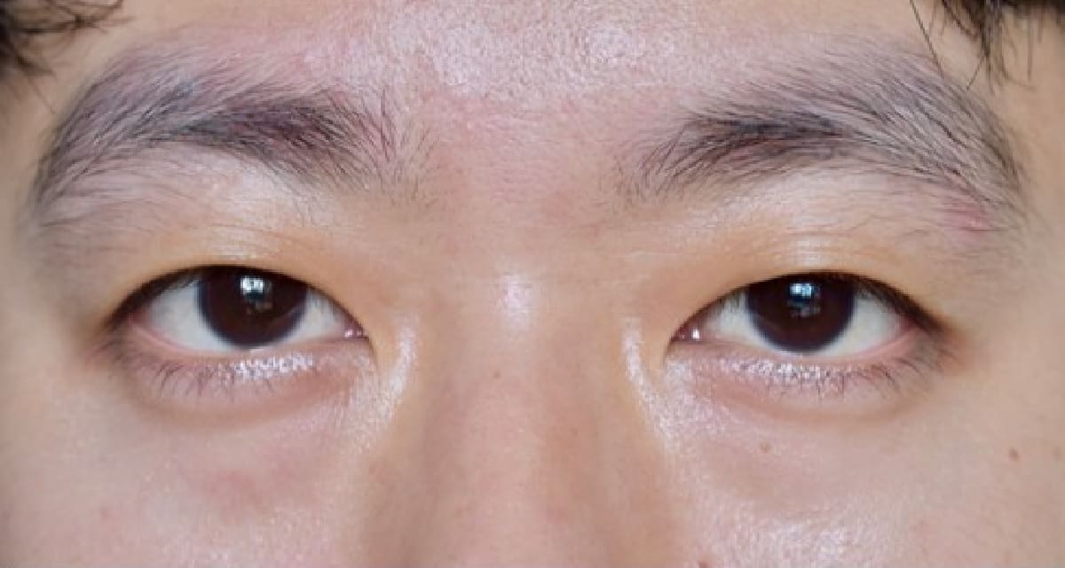 Monolid Eye Shapes: All You Need to Know | MyVision.org