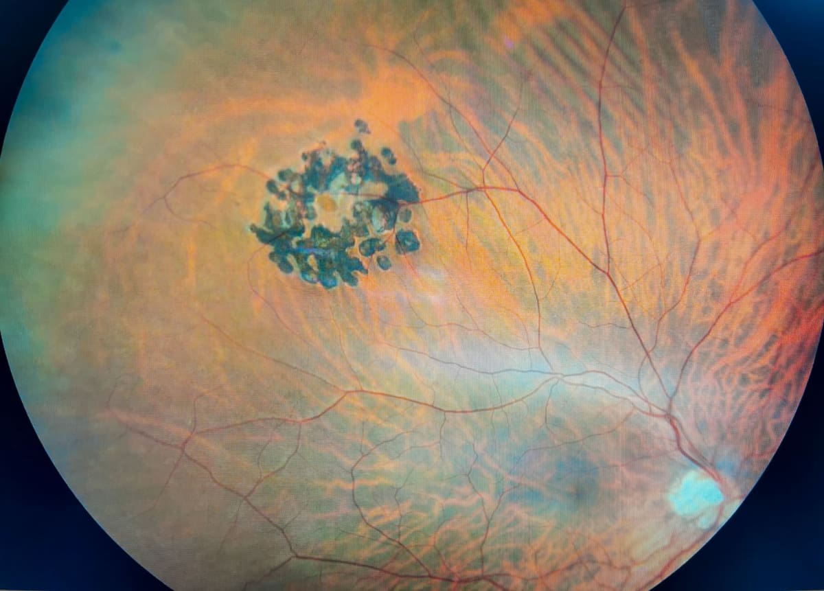 Retinal Holes Signs Symptoms Treatment MyVision Retinal Holes Signs Symptoms Treatment MyVision