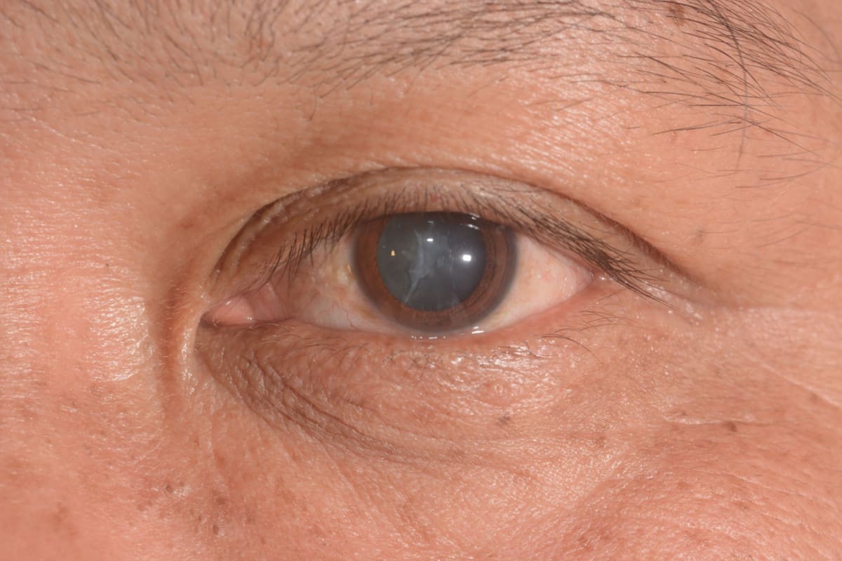 What Do Cataracts Look Like MyVision