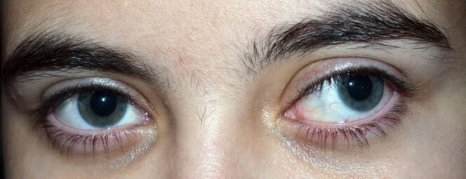 Eye Conditions & Diseases: What You Need to Know | MyVision.org